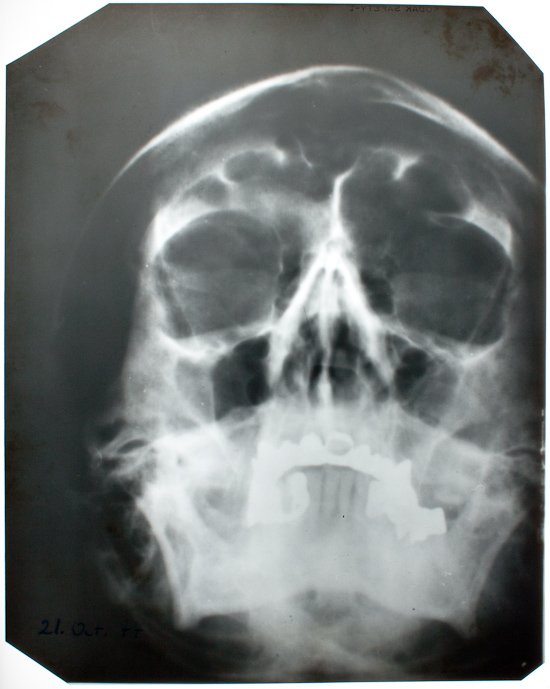AN X-RAY OF ADOLF HITLER'S SKULL : Lot 0513