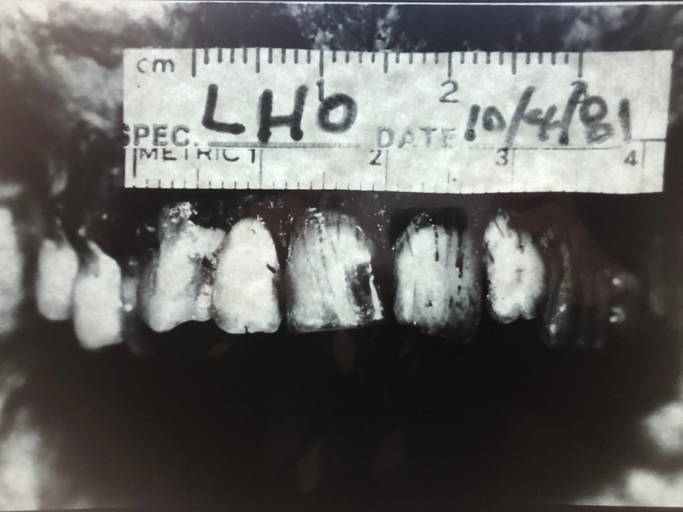 Lee Harvey Oswald Exhumed Head