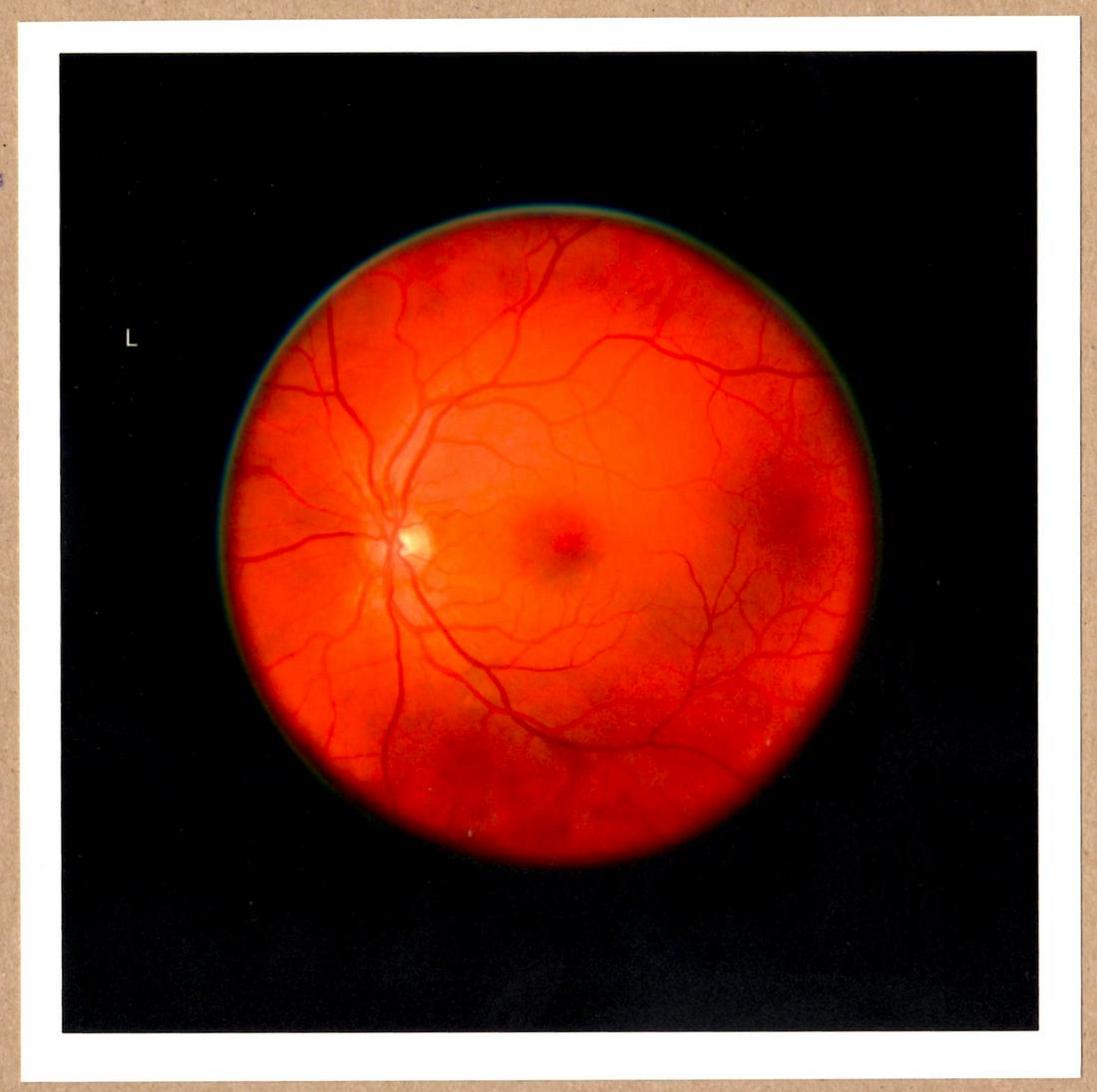 Signed Mikhael Subotzky Retinal Self Portrait, Left Eye Ltd 6" X 6 ...